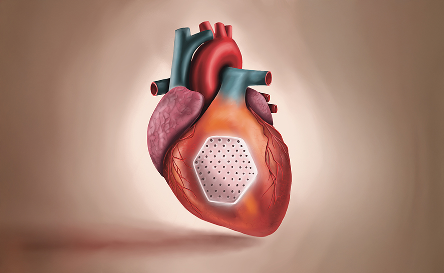 Study results open door to heart failure treatment with 'heart patch’